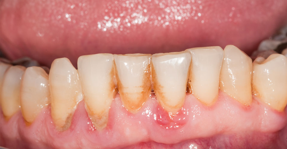 Parodontopatia o piorrea, la prevenzione è la cura | Cronache Maceratesi